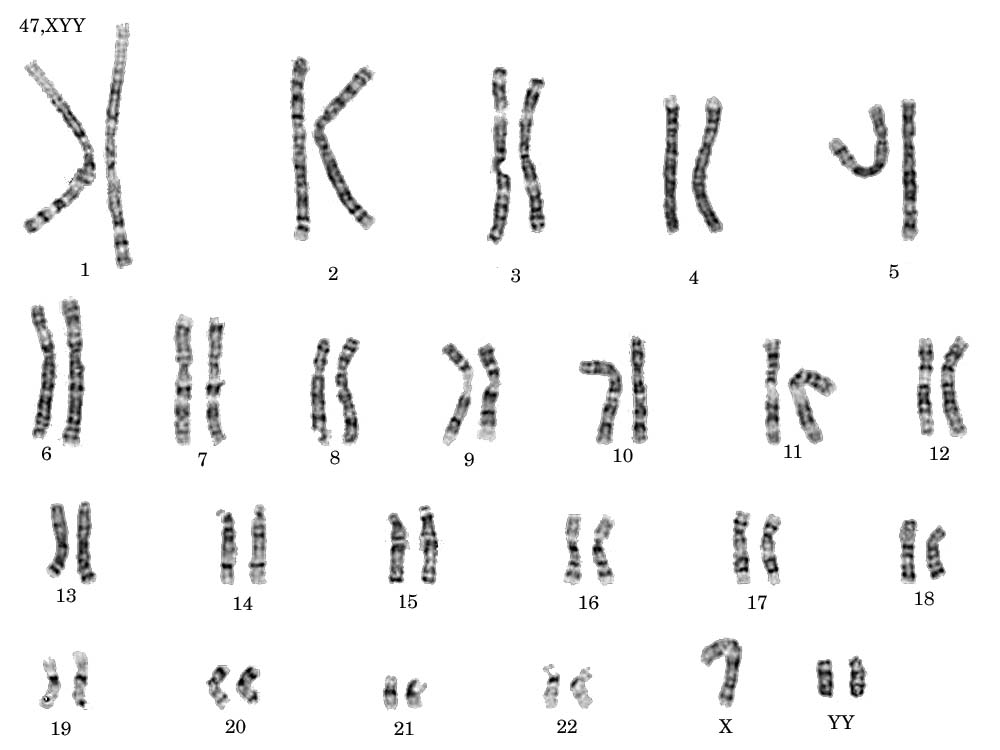Xyy Syndrome Diagram Xyy Syndrome Diagram